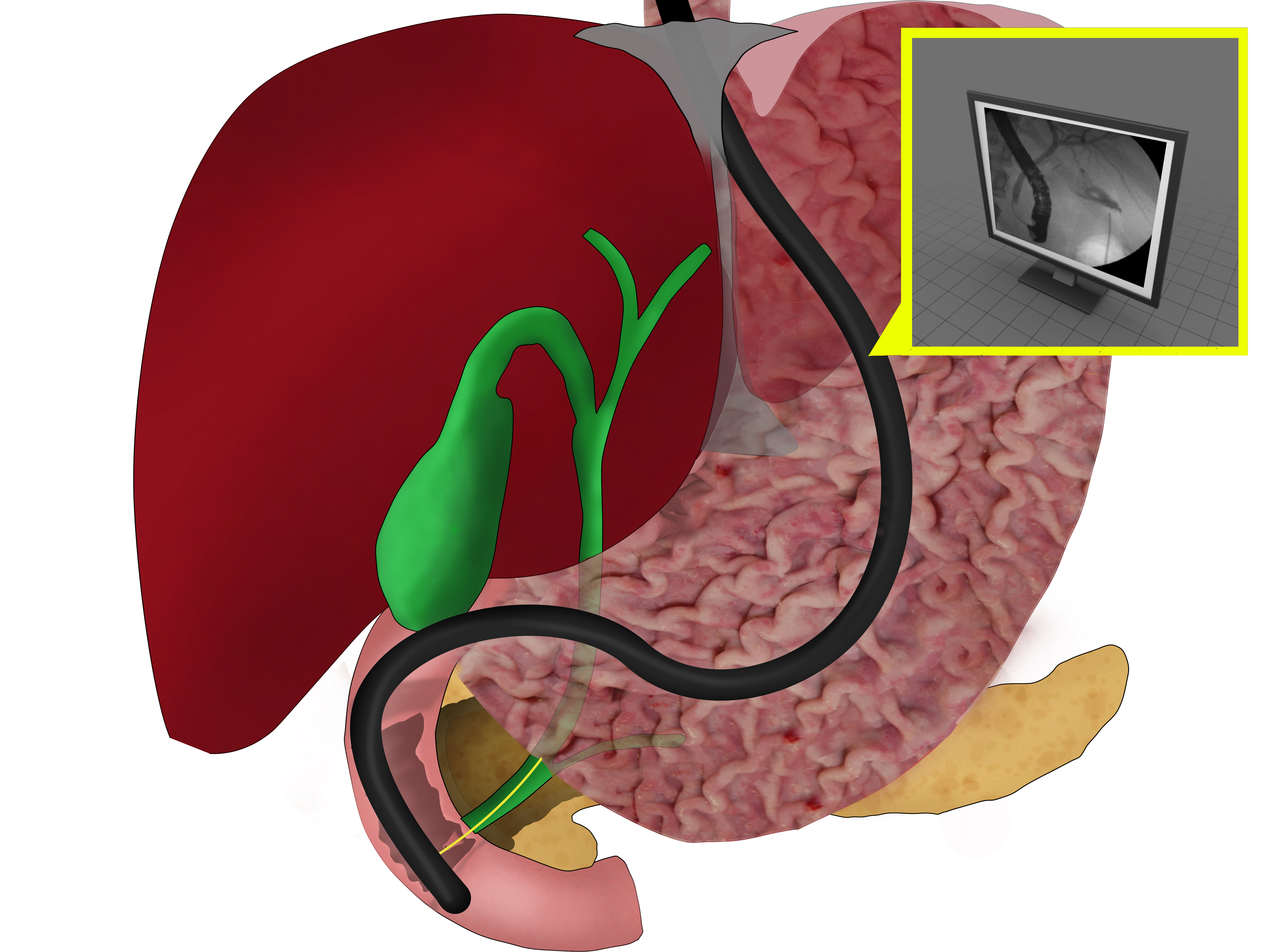 ercp.jpeg
